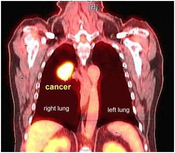 Karcinom pluca | SEMINARSKI RAD IZ MEDICINE